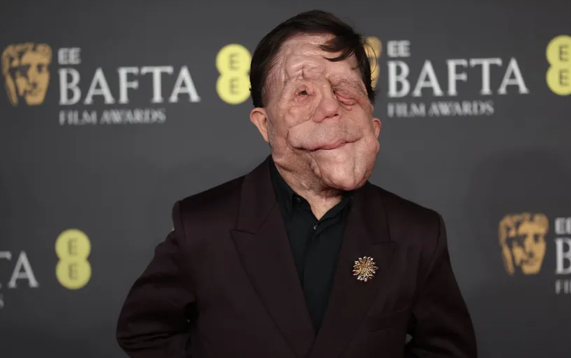 Adam Pearson, actor de 'Un hombre diferente', es víctima de ...